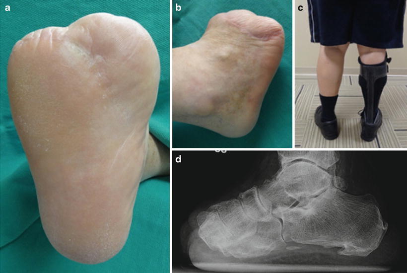 Transmetatarsal and Lisfranc Amputation | SpringerLink