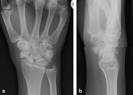 Proximal Row Carpectomy for Scaphoid Nonunion Advanced Collapse Wrist ...