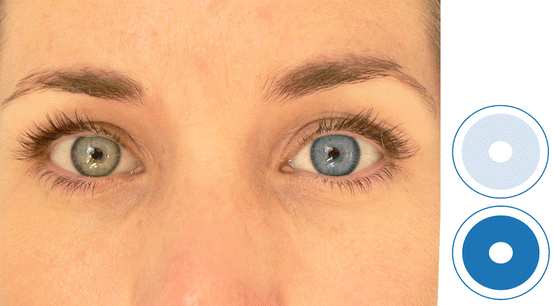 Scleral Shell Prostheses and Prosthetic Contact Lenses | SpringerLink