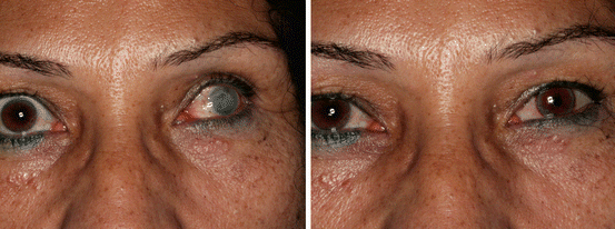 Scleral Shell Prostheses and Prosthetic Contact Lenses | SpringerLink