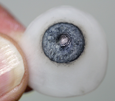 Scleral Shell Prostheses and Prosthetic Contact Lenses | SpringerLink