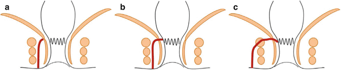 Ligation of the Intersphincteric Fistula Tract (LIFT) | SpringerLink