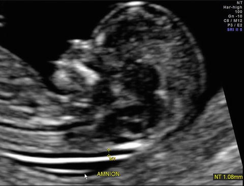 Fetal Biometry in Early Pregnancy | SpringerLink