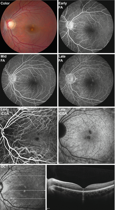 Punctate Inner Choroidopathy | SpringerLink