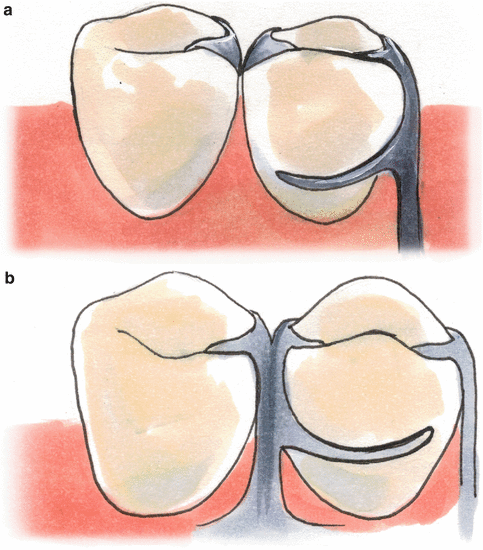 Direct and Indirect Retainers | SpringerLink
