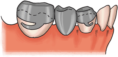 Direct and Indirect Retainers | SpringerLink