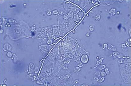 Candidiasis | SpringerLink