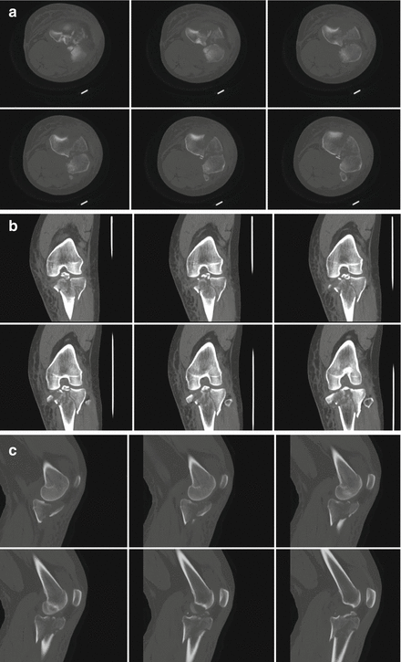 Bicondylar Tibial Plateau ORIF Technique | SpringerLink