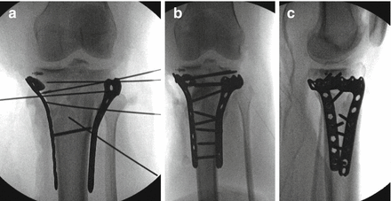 Bicondylar Tibial Plateau ORIF Technique | SpringerLink