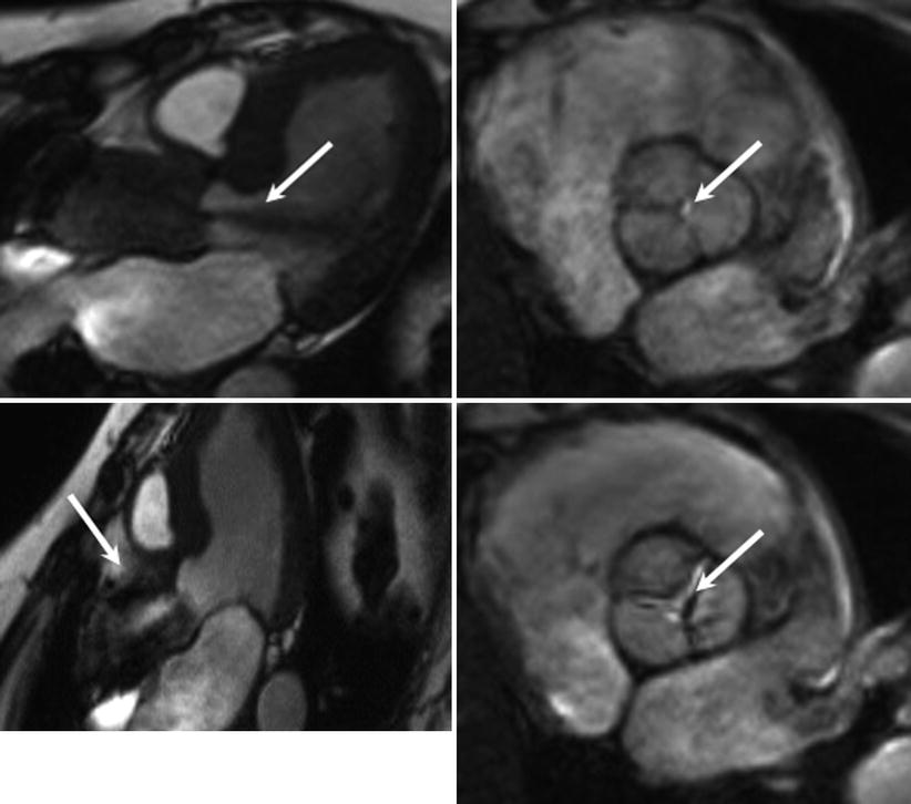 Cardiac Cine Imaging | SpringerLink
