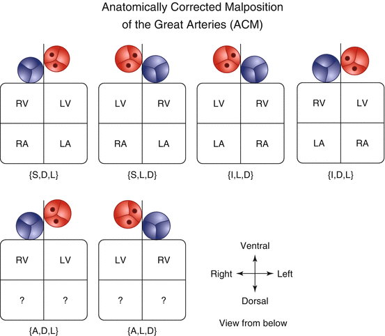 Anatomically Corrected Malposition of the Great Arteries | SpringerLink