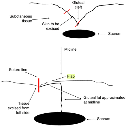 Pilonidal Disease | SpringerLink