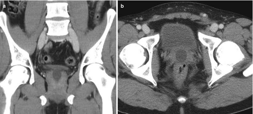 Imaging of Benign Prostatic Conditions | SpringerLink
