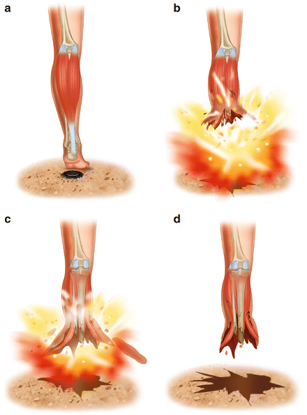 Dismounted Complex Blast Injuries | SpringerLink