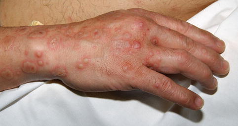 Stevens–Johnson Syndrome/Toxic Epidermal Necrolysis and Erythema ...