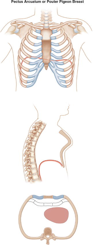 Other Chest Wall Deformities | SpringerLink