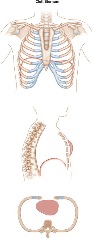 Other Chest Wall Deformities | SpringerLink