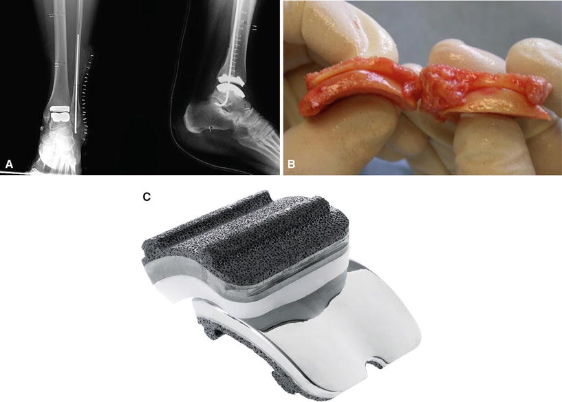 Primary Zimmer Trabecular Metal Total Ankle Replacement | SpringerLink