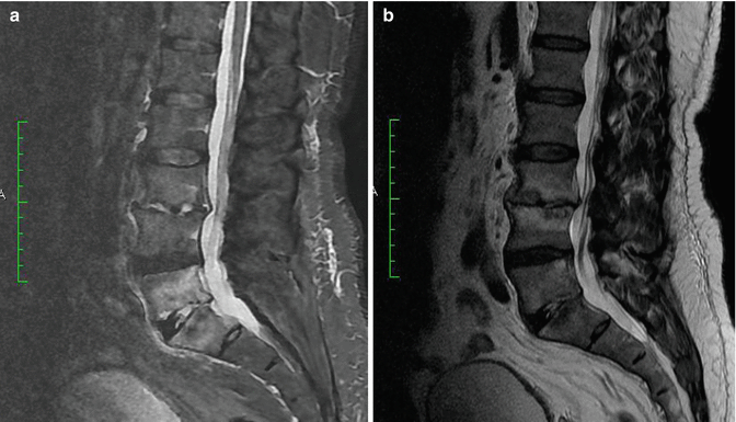 Imaging of Vertebral Brucellosis | SpringerLink