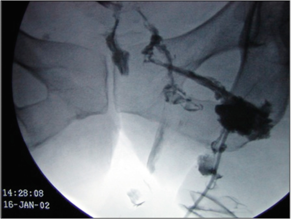 Anorectal Abscess and Fistula | SpringerLink
