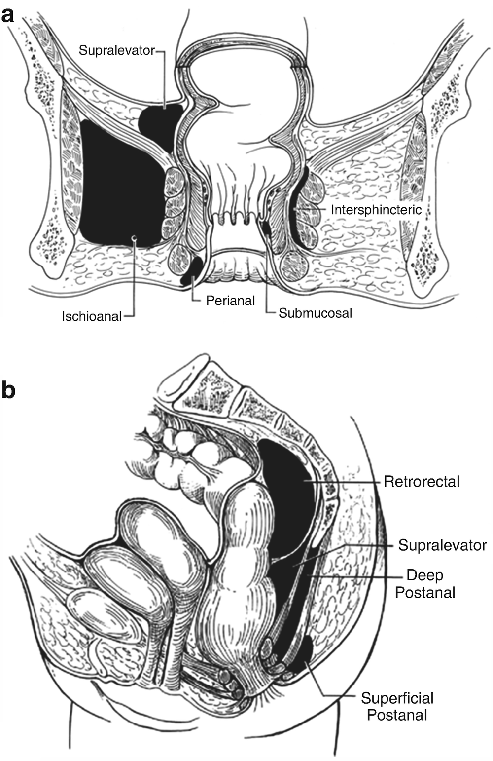 Anorectal Abscess and Fistula | SpringerLink