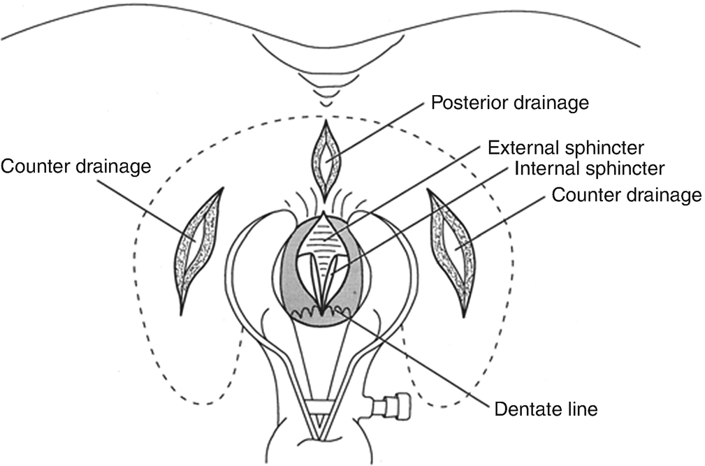 Anorectal Abscess and Fistula | SpringerLink