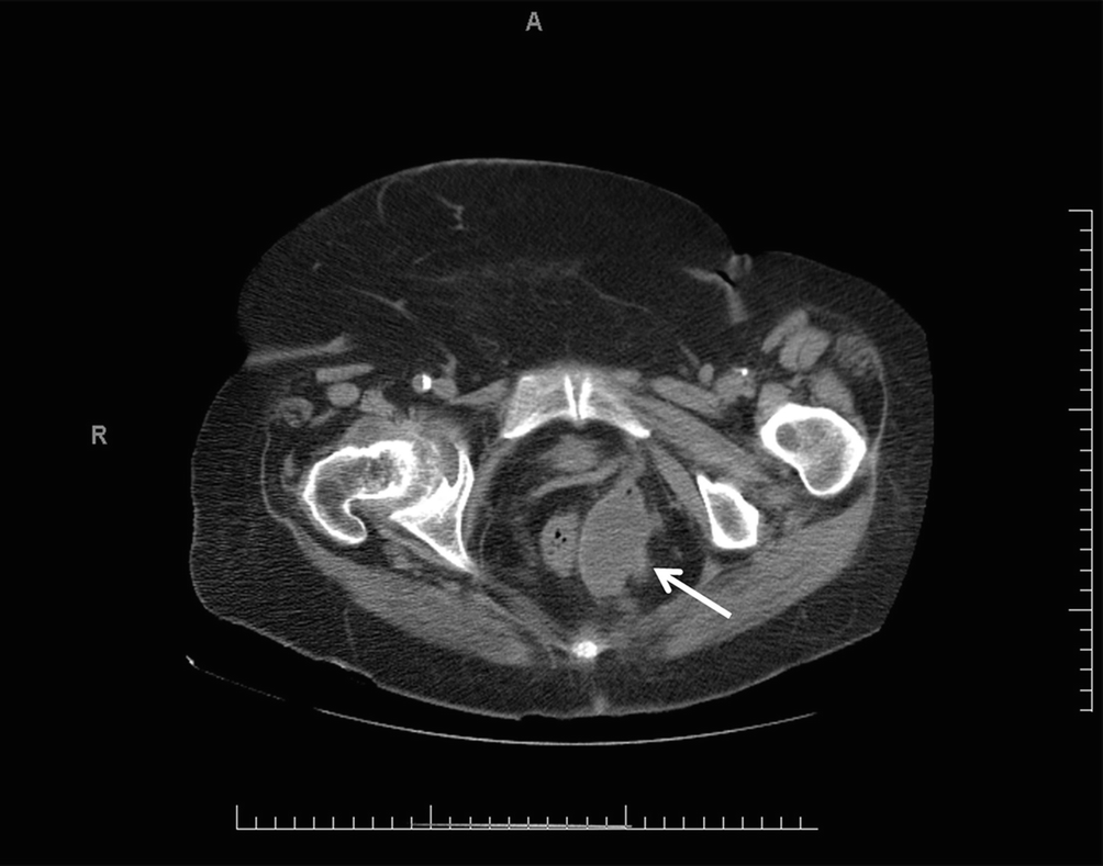 Complex Anorectal Fistulas | SpringerLink