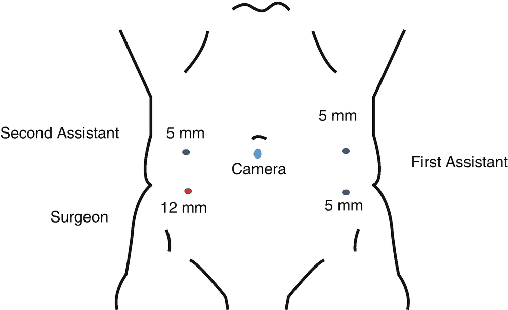 Proctectomy | SpringerLink