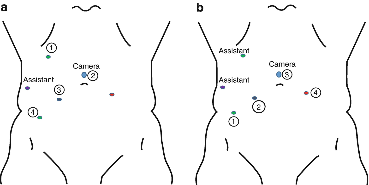 Proctectomy | SpringerLink