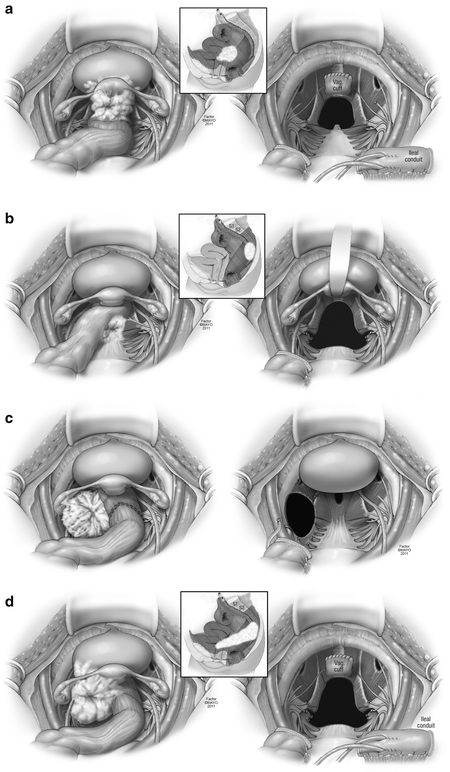 Colorectal Cancer: Management of Local Recurrence | SpringerLink