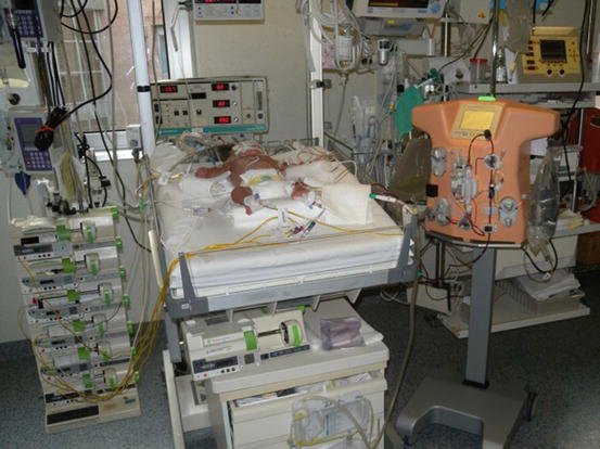 Continuous Renal Replacement Therapy (CRRT) | SpringerLink