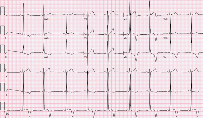 Cardiac Ischemia, Injury, and Infarction | SpringerLink