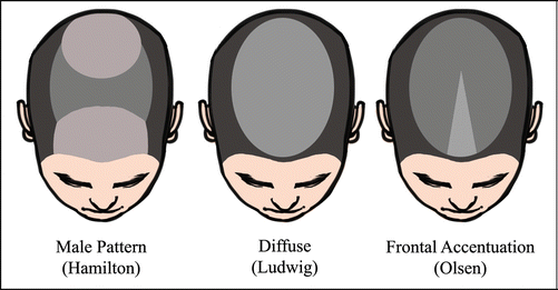 Classification and Scoring of Androgenetic Alopecia (Male and Female ...