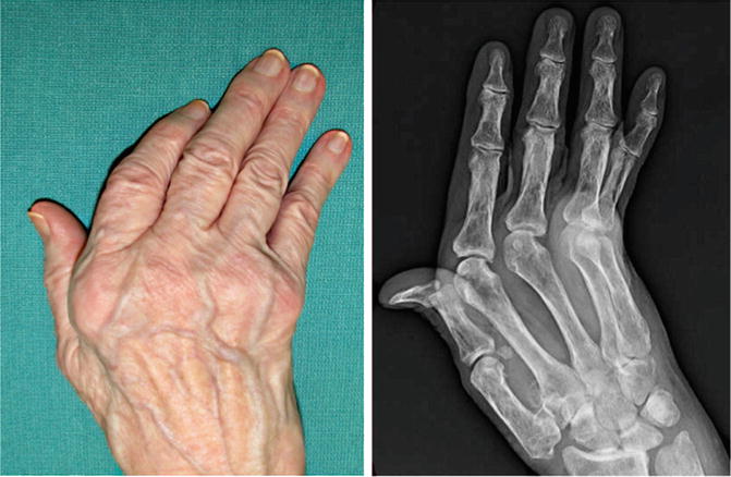 Concepts in Ulnar Drift Deformity | SpringerLink