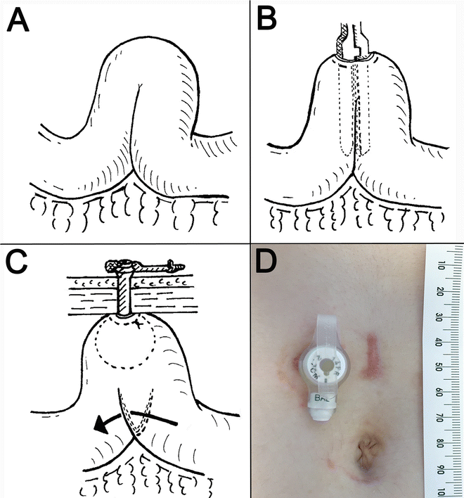Enteral Nutrition and Access | SpringerLink