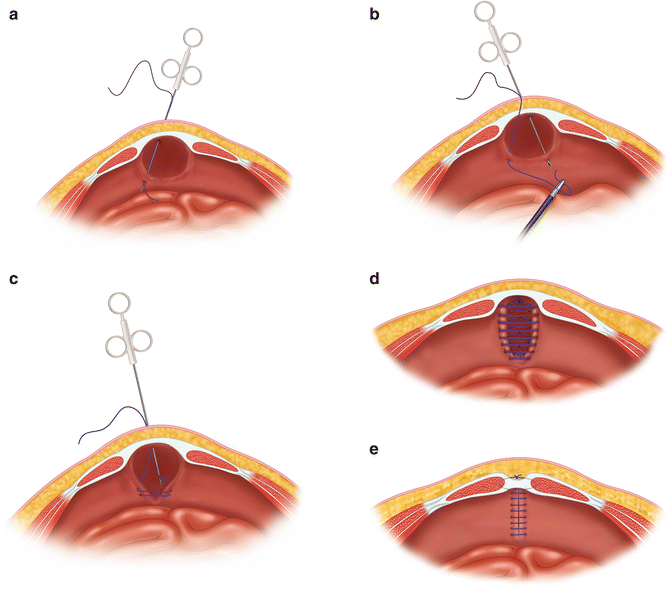 Laparoscopic Ventral Hernia Repair with Defect Closure | SpringerLink