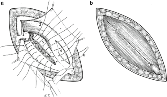 Groin Hernia Repair: Open Techniques | SpringerLink