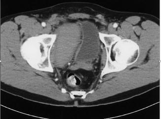 Groin Hernia Repair: Open Techniques | SpringerLink