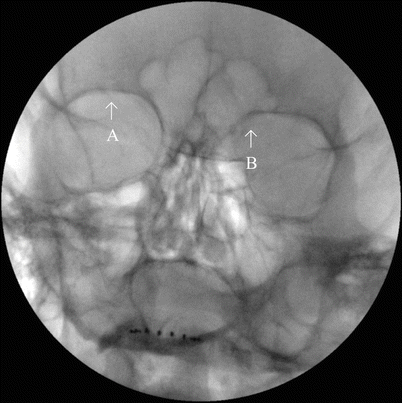 Supraorbital Nerve Entrapment | SpringerLink