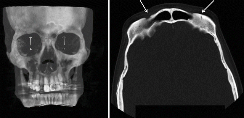 Supraorbital Nerve Entrapment: Face | SpringerLink