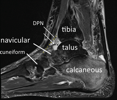 Deep Peroneal Nerve Entrapment | SpringerLink