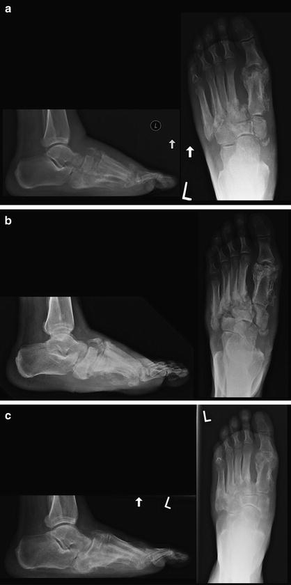 Pathophysiology of Diabetes and Charcot Neuroarthropathy | SpringerLink