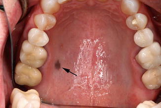 Pigmented Lesions of the Oral Mucosa | SpringerLink