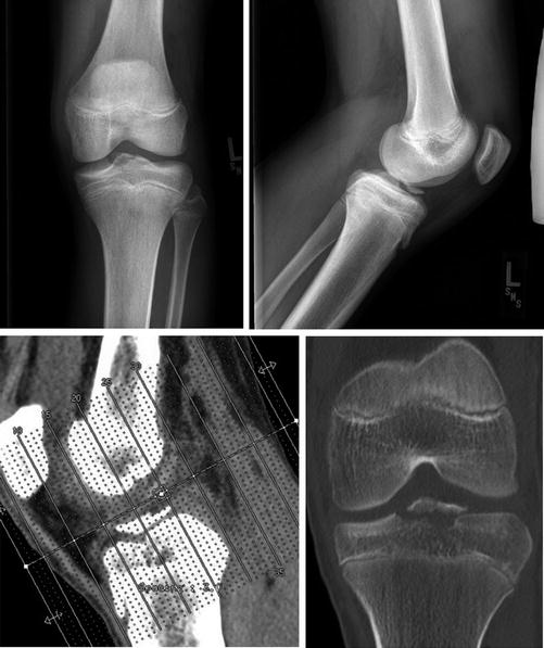 Arthroscopic Treatment of Tibial Spine Fractures | SpringerLink