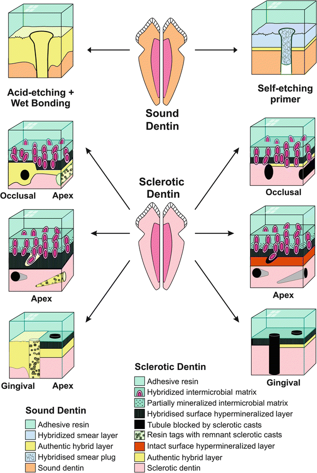 Cervical Sclerotic Dentin: Resin Bonding | SpringerLink