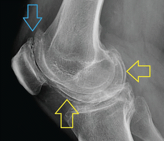 Radiology and Ultrasonography Findings in Chondrocalcinosis | SpringerLink