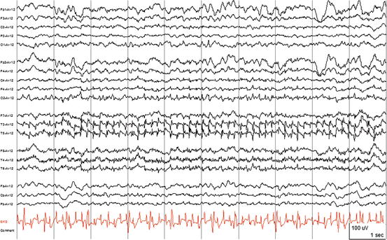 Artifacts Resembling Seizures | SpringerLink