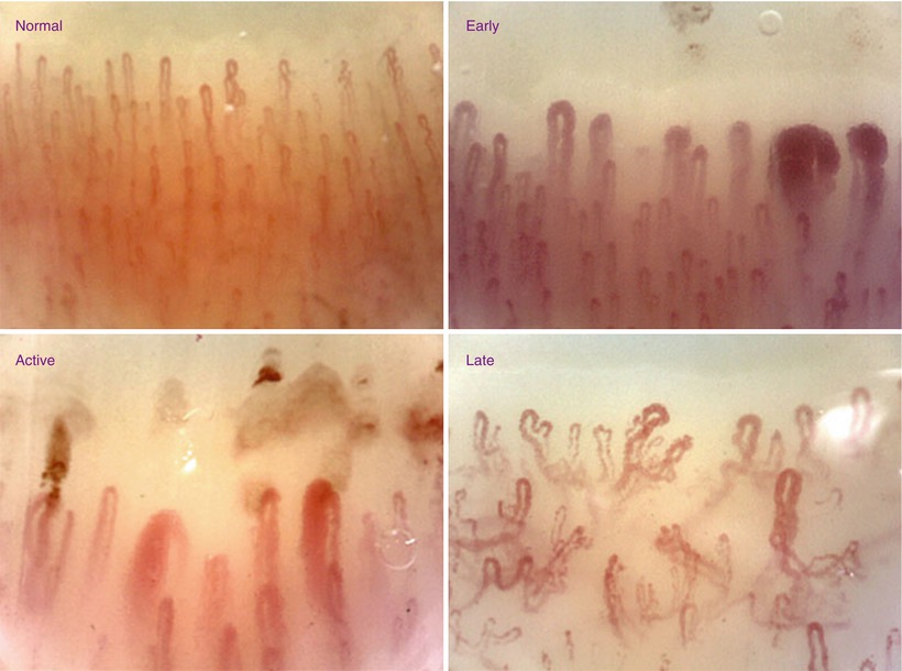 Raynaud’s Phenomenon, Digital Ulcers and Nailfold Capillaroscopy ...