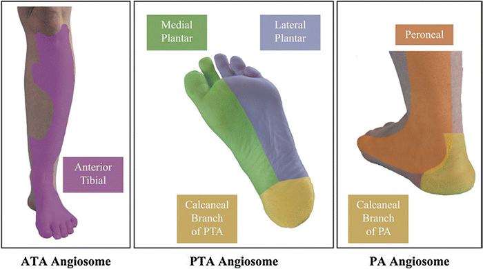 Critical Limb Ischemia and the Angiosome Model | SpringerLink