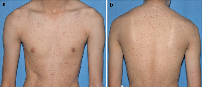 Childhood Psoriasis | SpringerLink